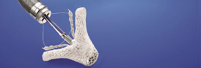 Heart & Vascular Care | Transcatheter Mitral Valve Repair | Powers Health