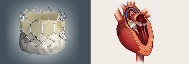 Heart & Vascular Care | TAVR | Powers Health