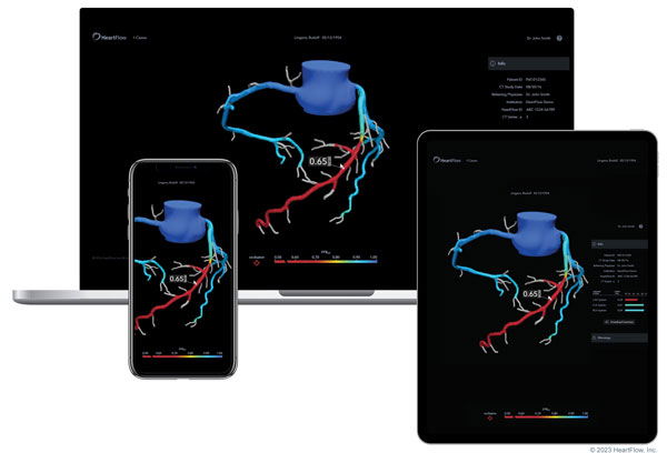 Community Healthcare System adopts HeartFlow Analysis | Powers Health