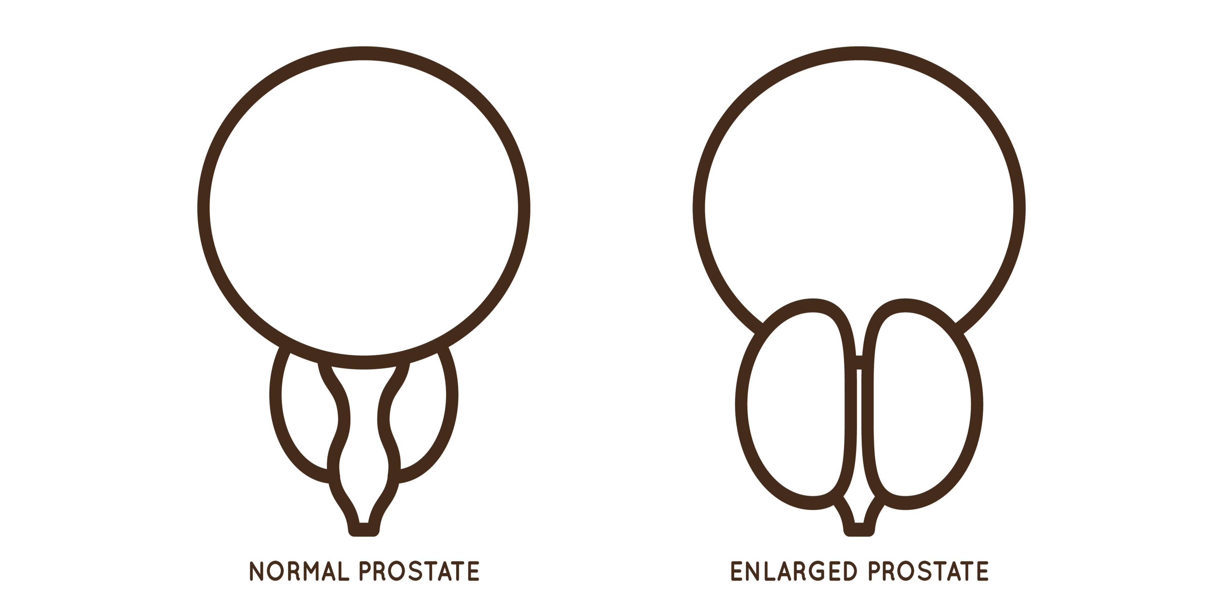 What Is an Enlarged Prostate and How Do You Treat It | Powers Health