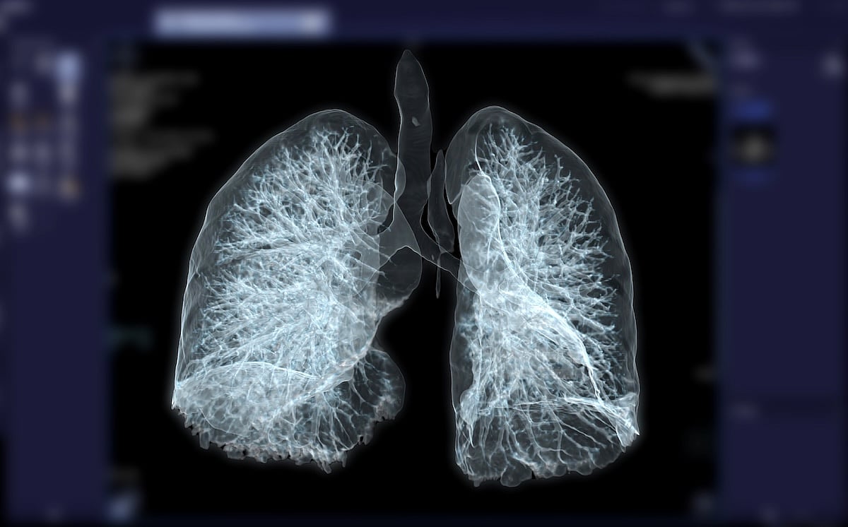 Chest CT Scans Can Help Diagnose Pneumonia | Powers Health